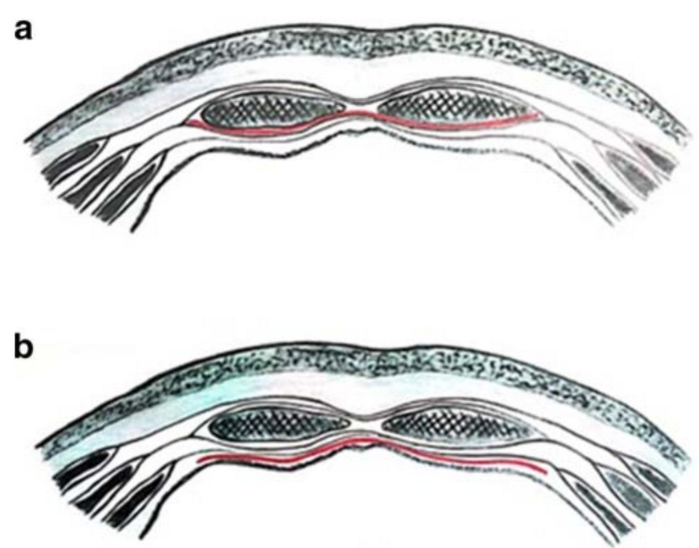 Sublay mesh repair placement in red colour. retromuscular