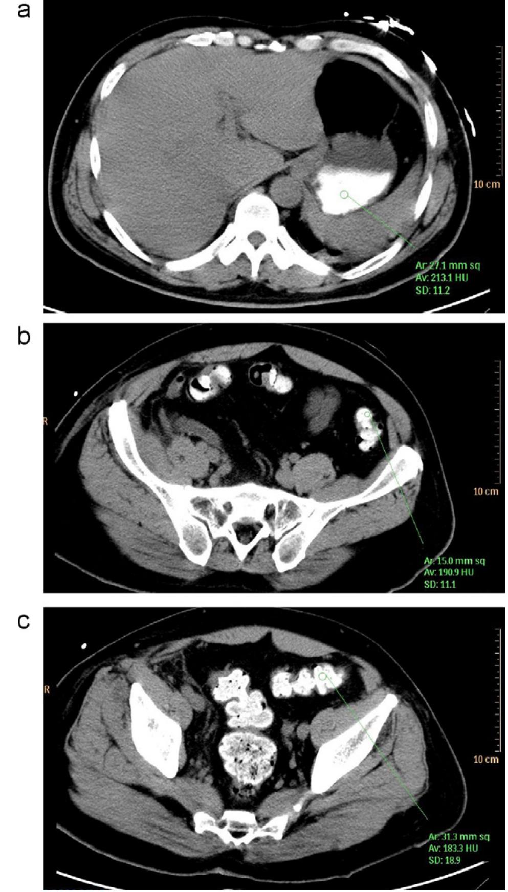 (PDF) Medications as causes of intraluminal hyperdensities: What ...