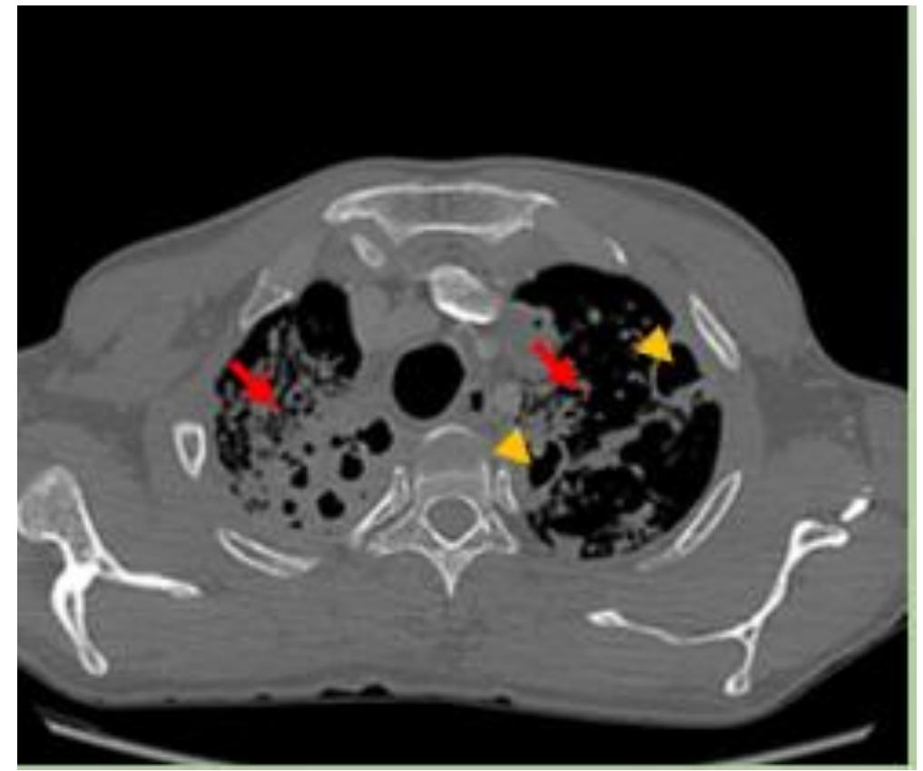 Multiple bilateral cervical lymph node enlargements were