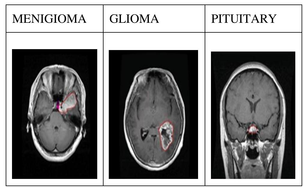 Depicts the brain tumor classifications respectively, these