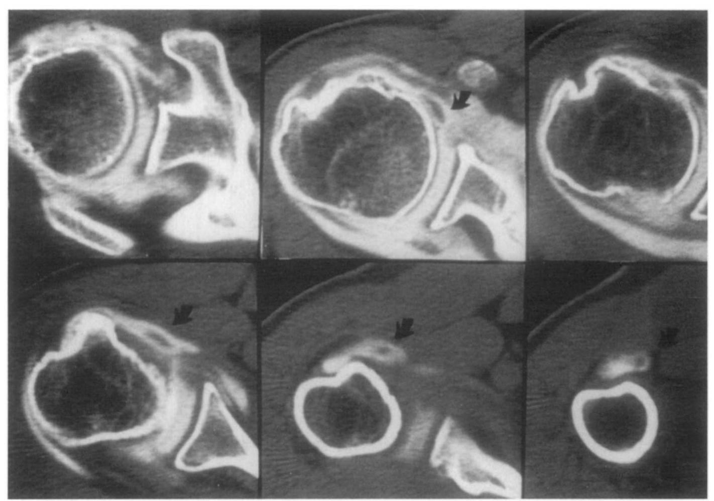 Dislocation of long biceps tendon total loss of contact