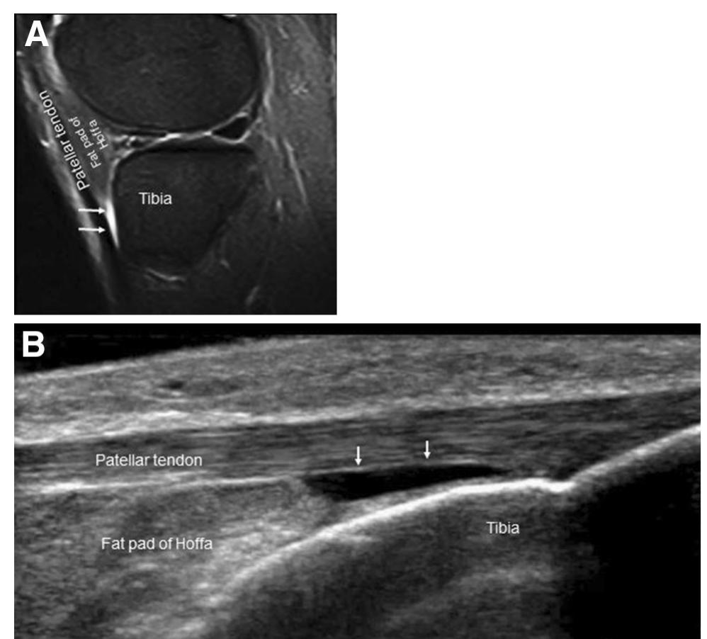 Deep infrapatellar bursa, sagittal proton density fat