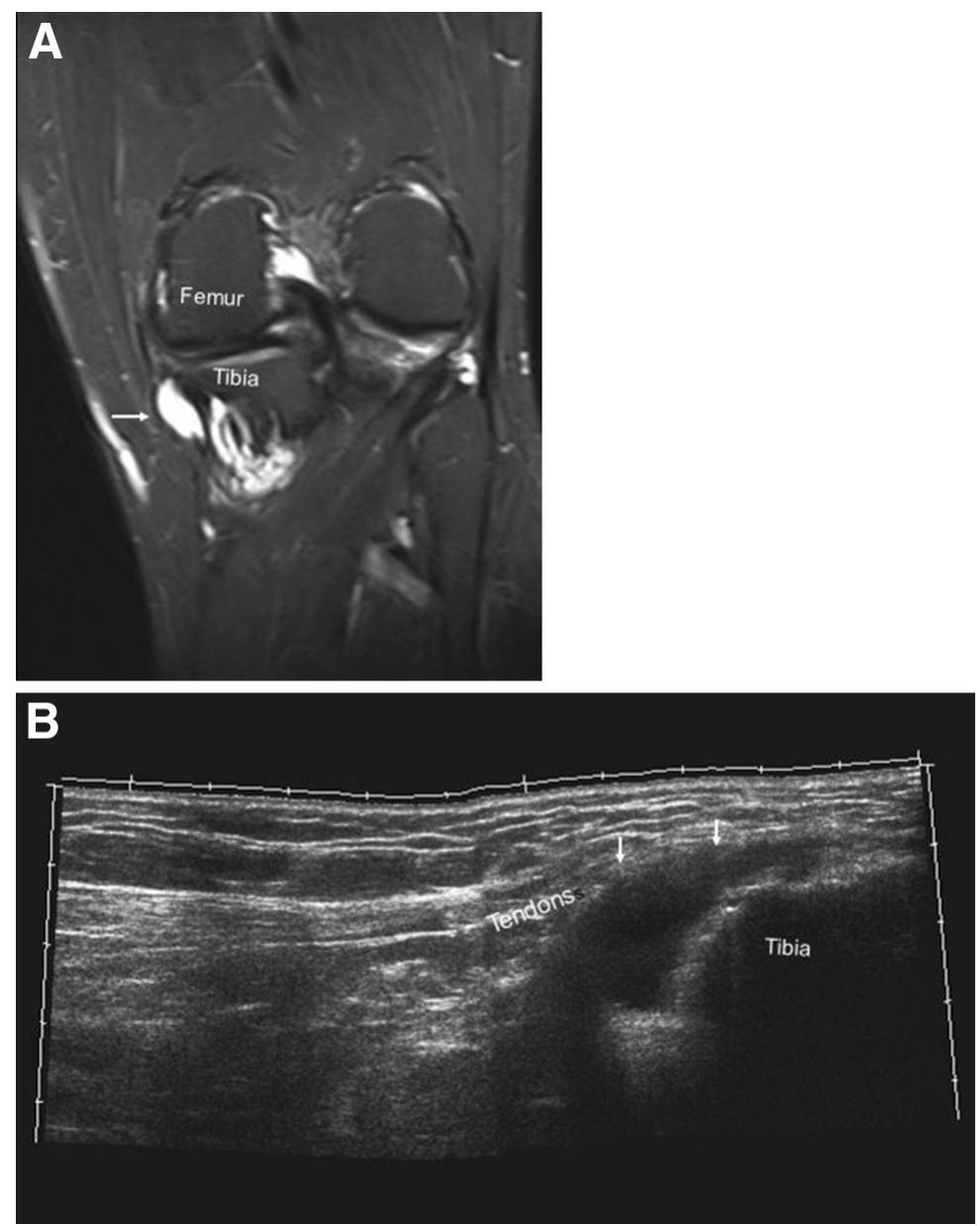 Pes anserine bursa, coronal proton density fat suppressed
