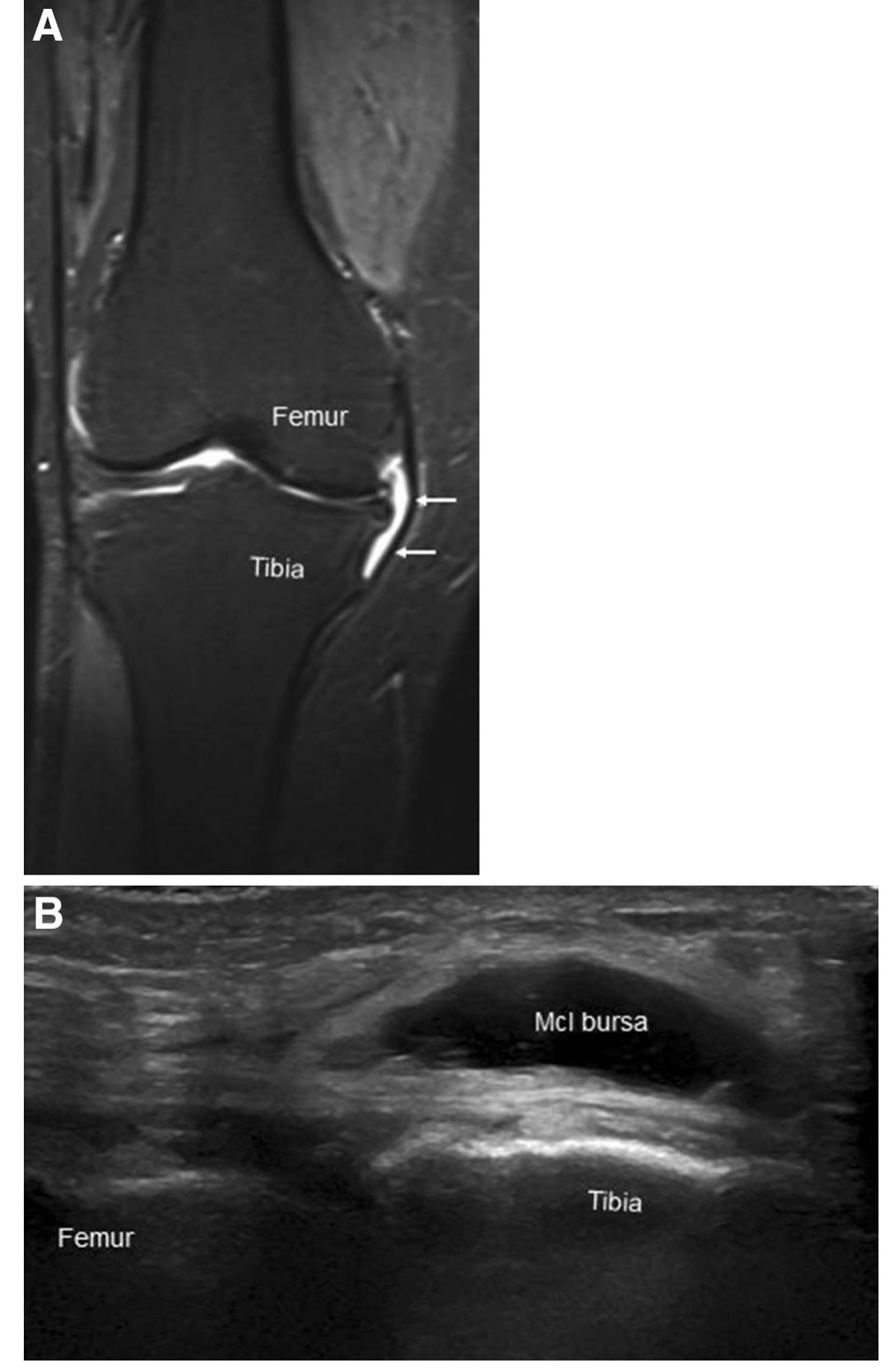 Medial collateral ligament bursa, coronal proton density fat