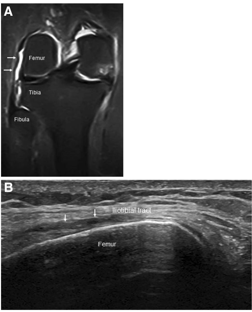 [liotibial bursa, coronal proton density fat suppressed