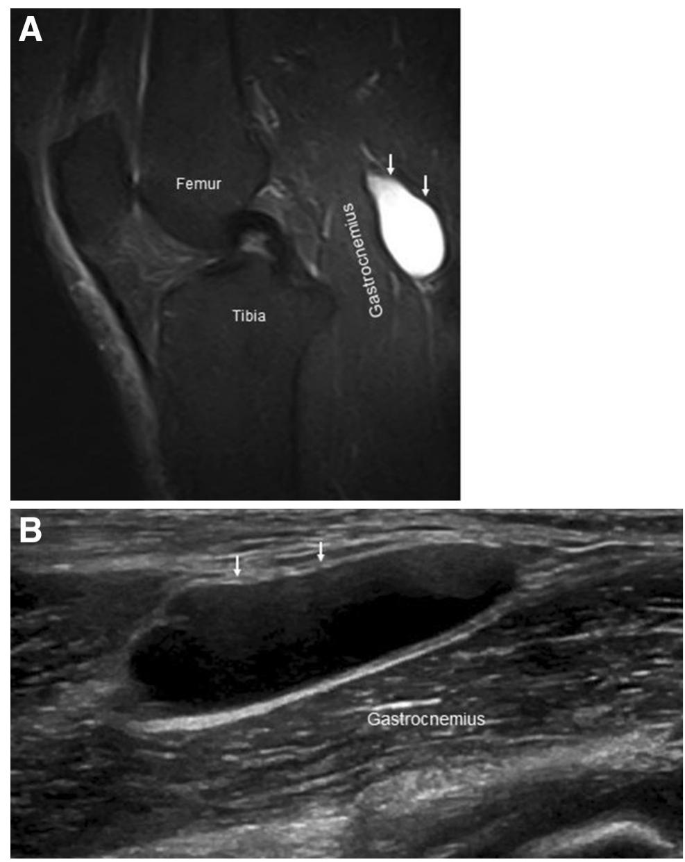 Popliteal (baker’s) cyst, sagittal proton density fat sup-