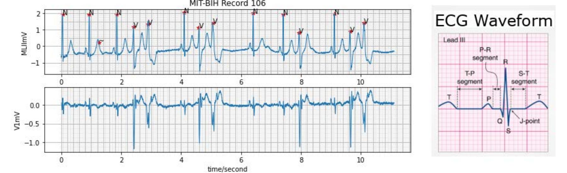 Sample of an ecg signal from the mit-bih database with a