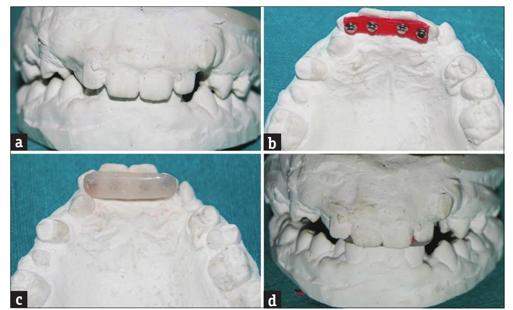 (a) maxillary and mandibular cast in occlusion demonstrating
