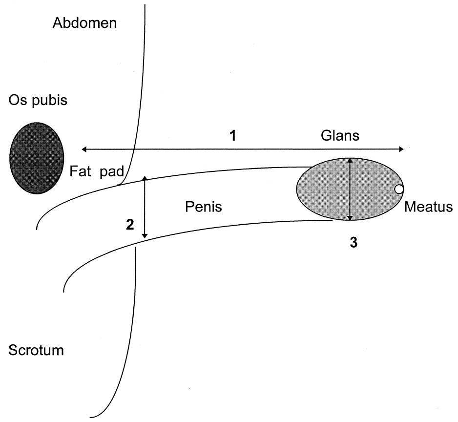 Penile measurement in the flaccid and erect state: 1, penile