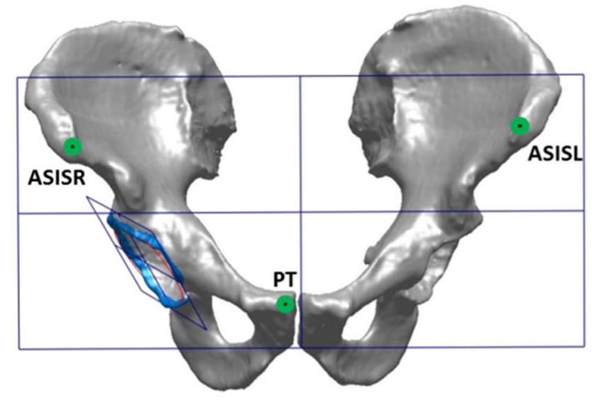 Step 1: defining the acetabular ridge circle