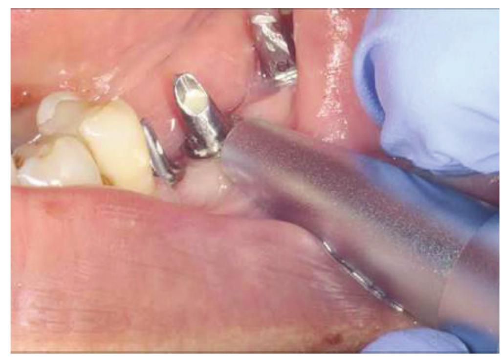 Application of periotest. the measurements are significantly