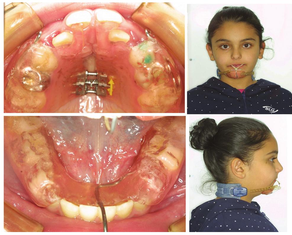 Intraoral and extraoral photographs of mini maxillary