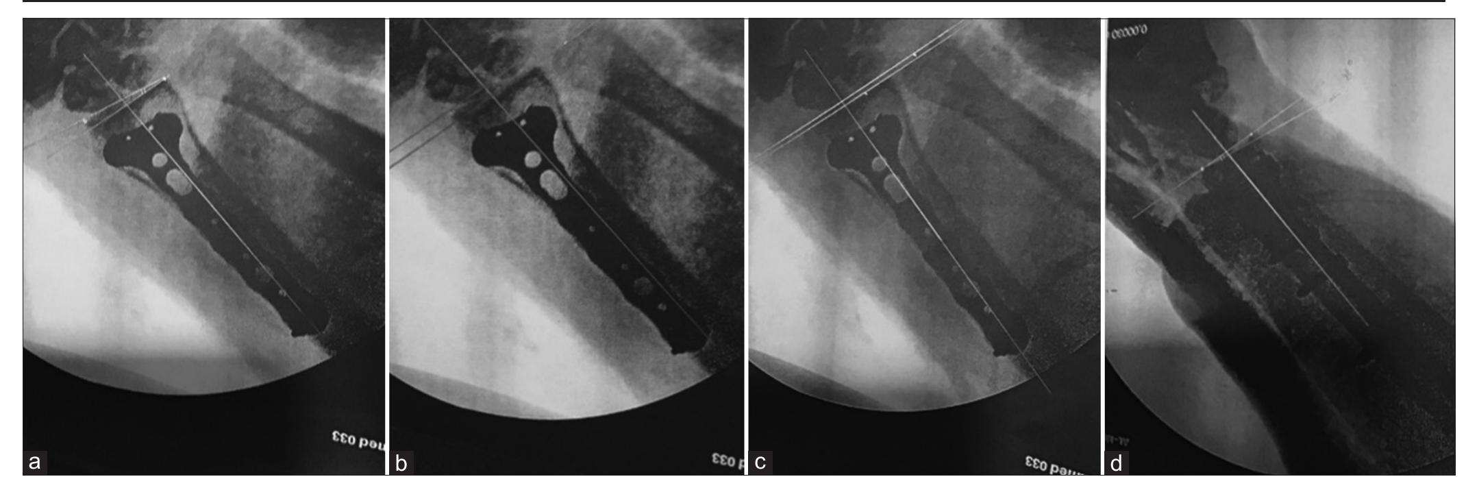 Post-operative measurement. (a) radial inclination 15°, (b)