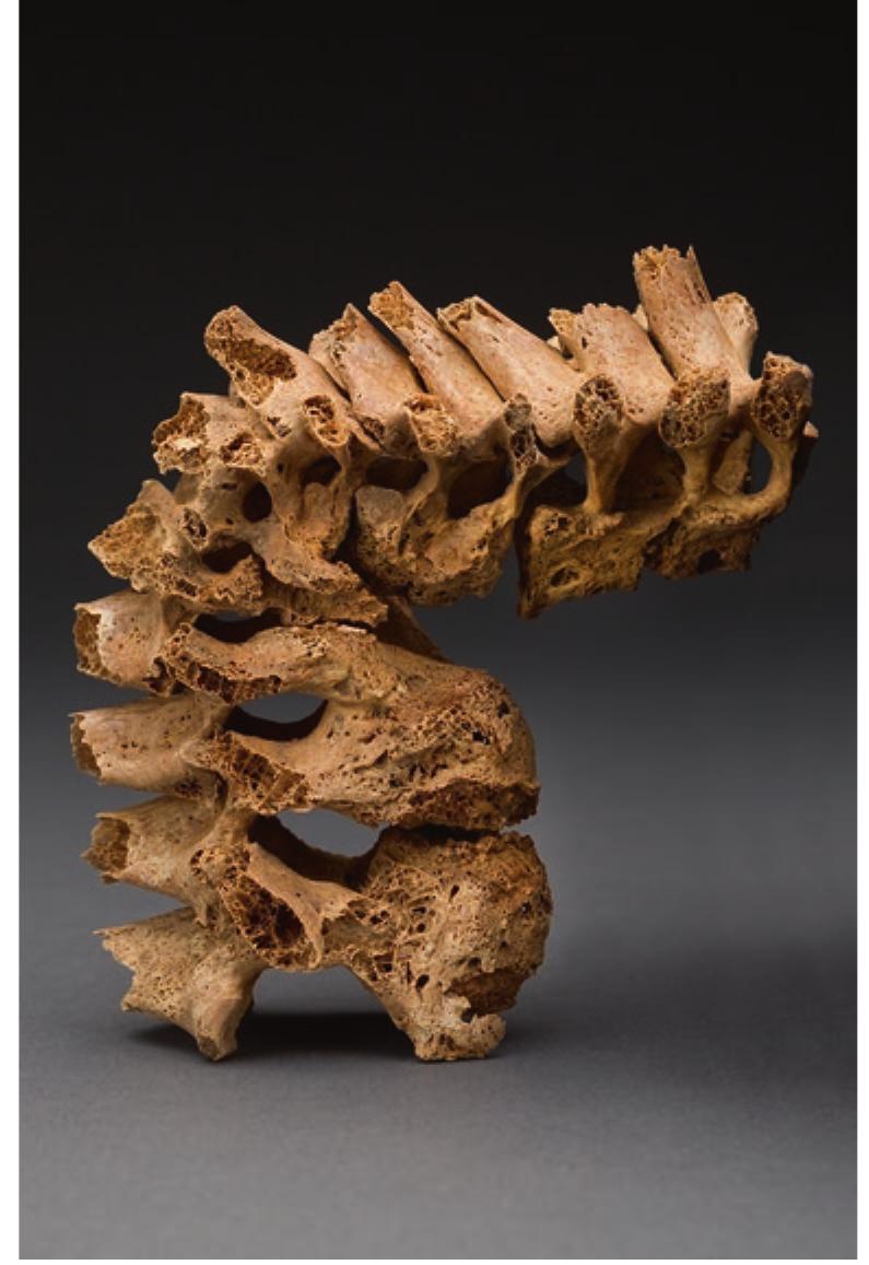 Anterior surface of the sacrum has lytic destruction and