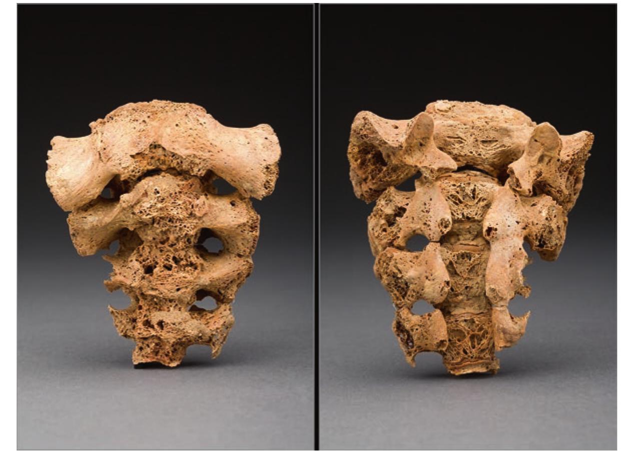 9 destructive lesions on the anterior and posterior surfaces
