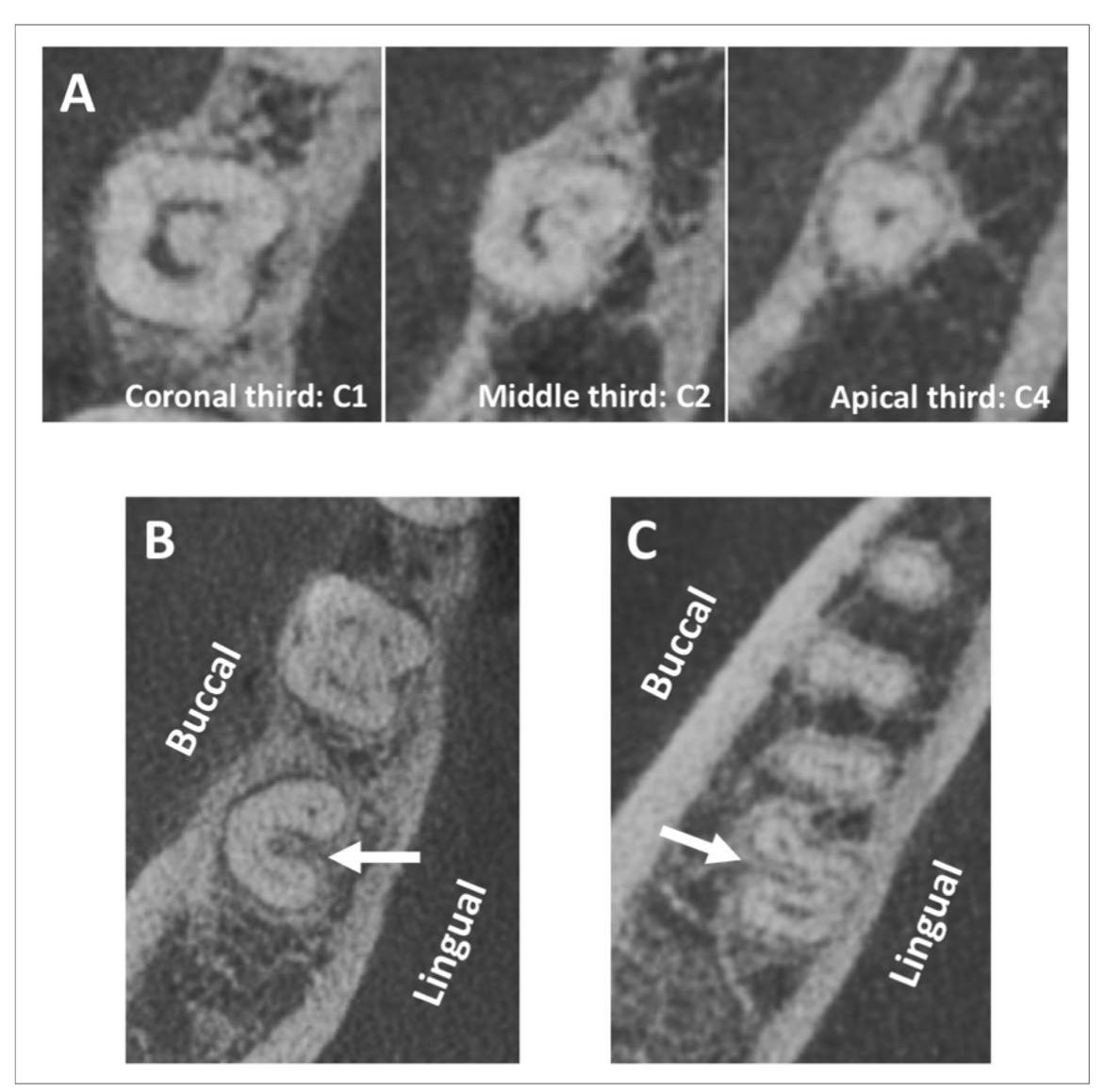 (a) axial cross section of mandibular molar showing the
