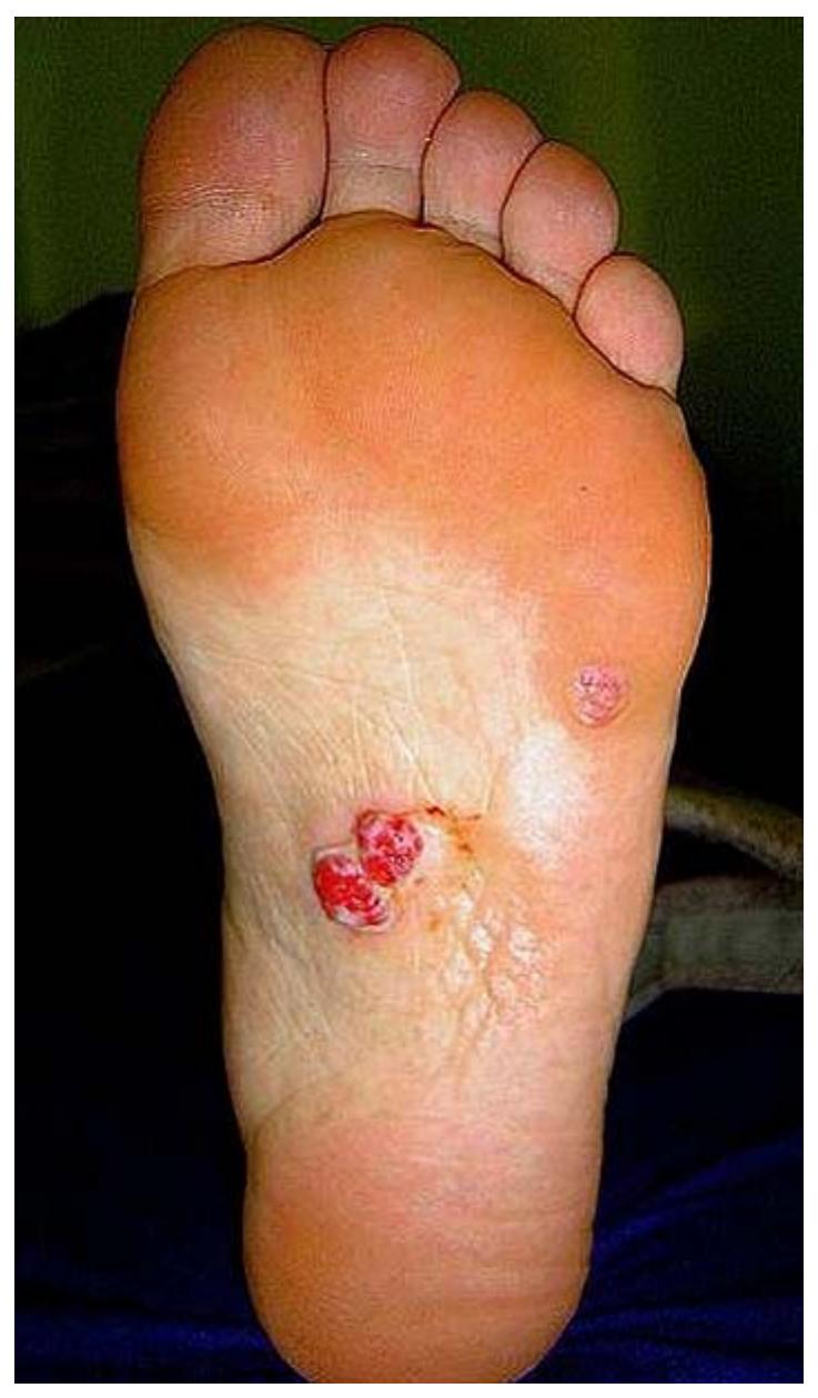 Small nodules on the plantar skin of the left foot