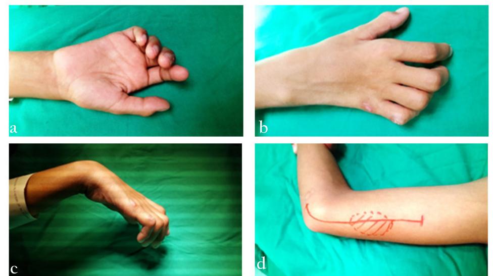 (a-c) shows wasting of hypothenar muscles, hollowing of the
