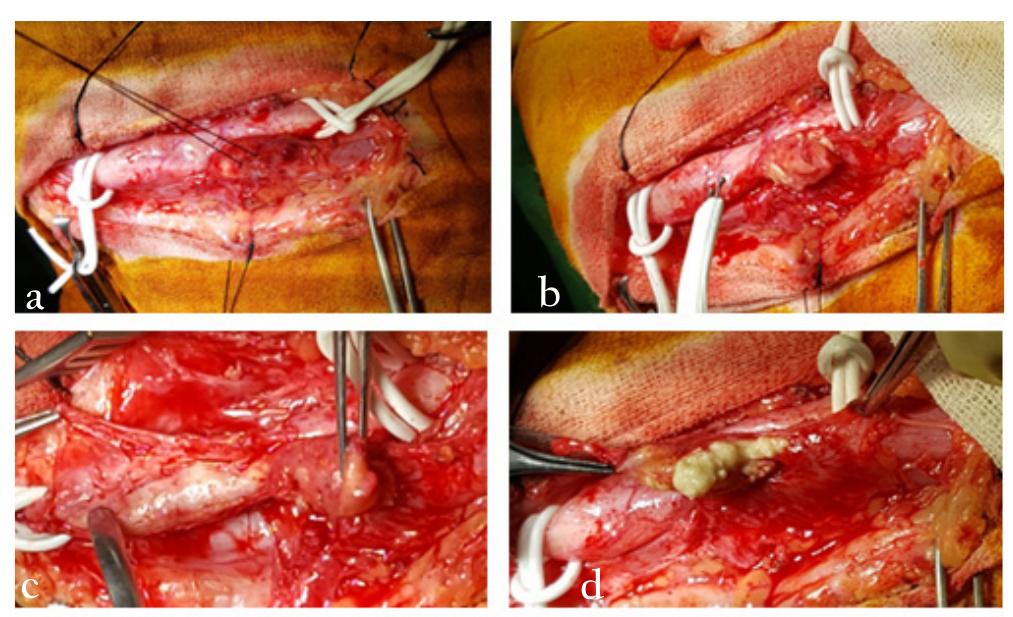 At surgery, the ulnar nerve above the elbow was thickened