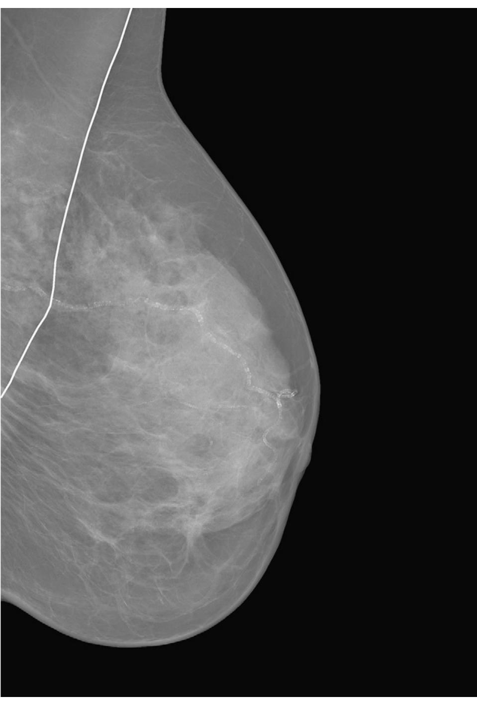 Annotation example: pectoral muscle.