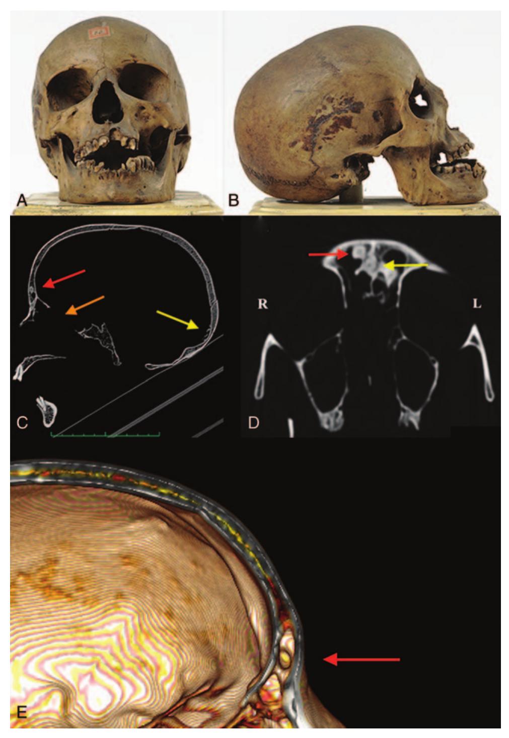 A. frontal view of skull eg36. b. lateral view of skull