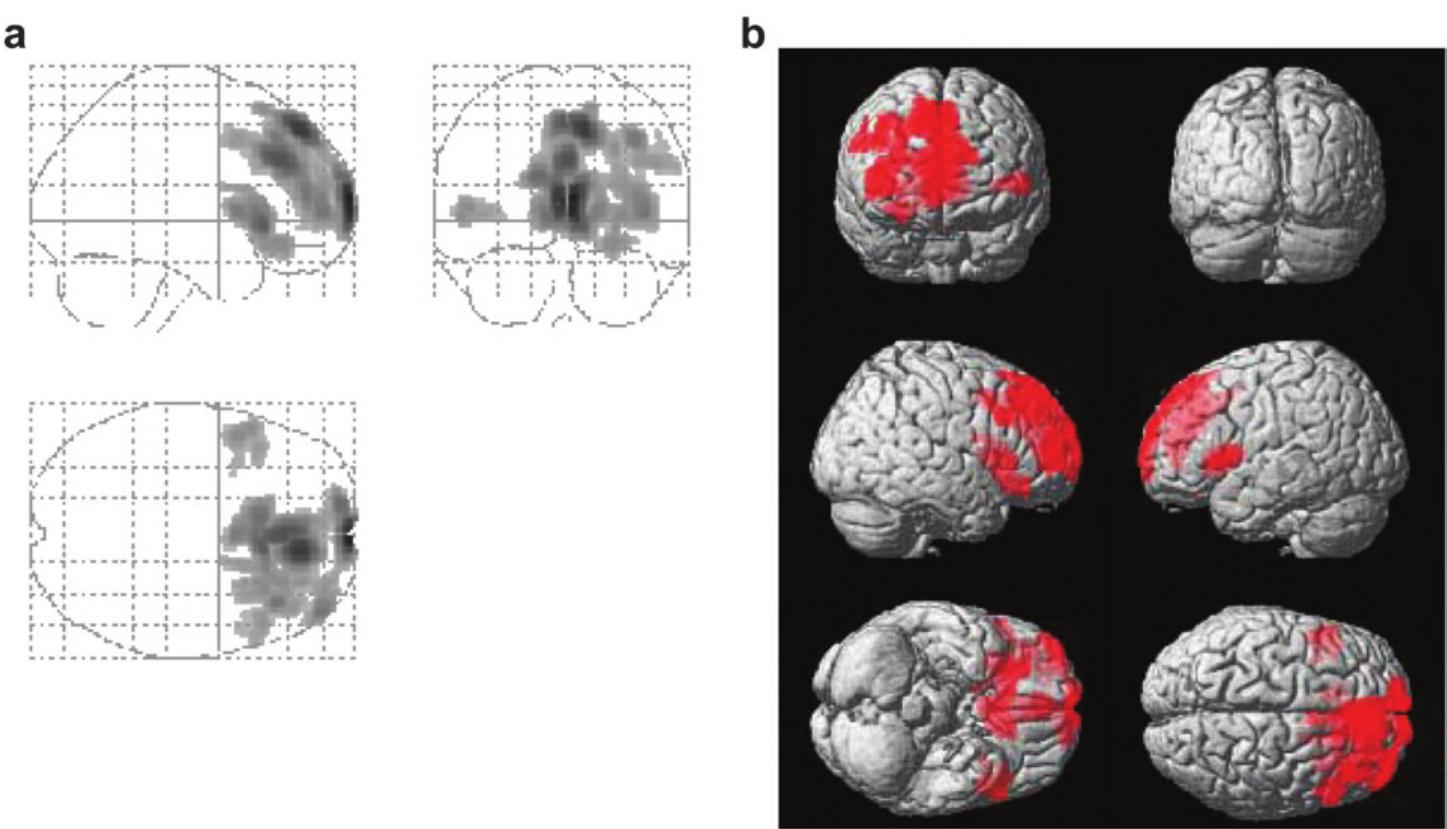 Results of voxel-based analysis of cbf decreases with age.