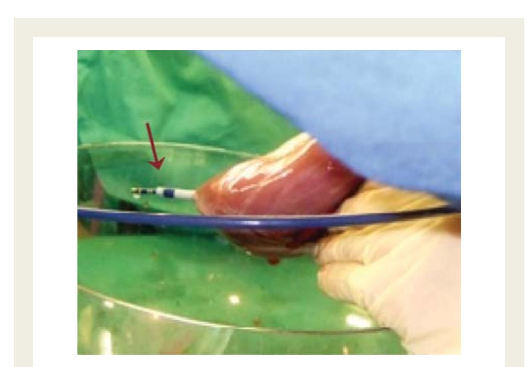 Left ventricular perforation with catheter within a sheath.