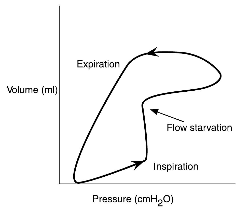 Pv loop illustrating flow dyssynchrony. notice the concave