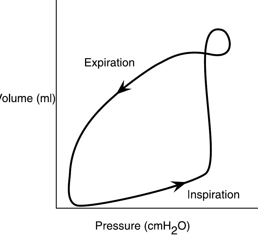Pv loop illustrating flow dyssynchrony. notice the figure
