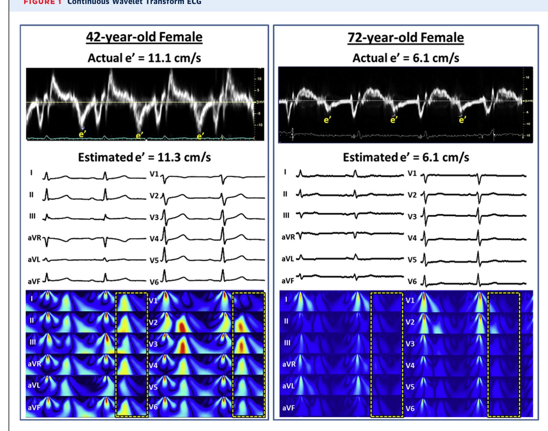 Tissue doppler mitral annular velocity (top), traditional