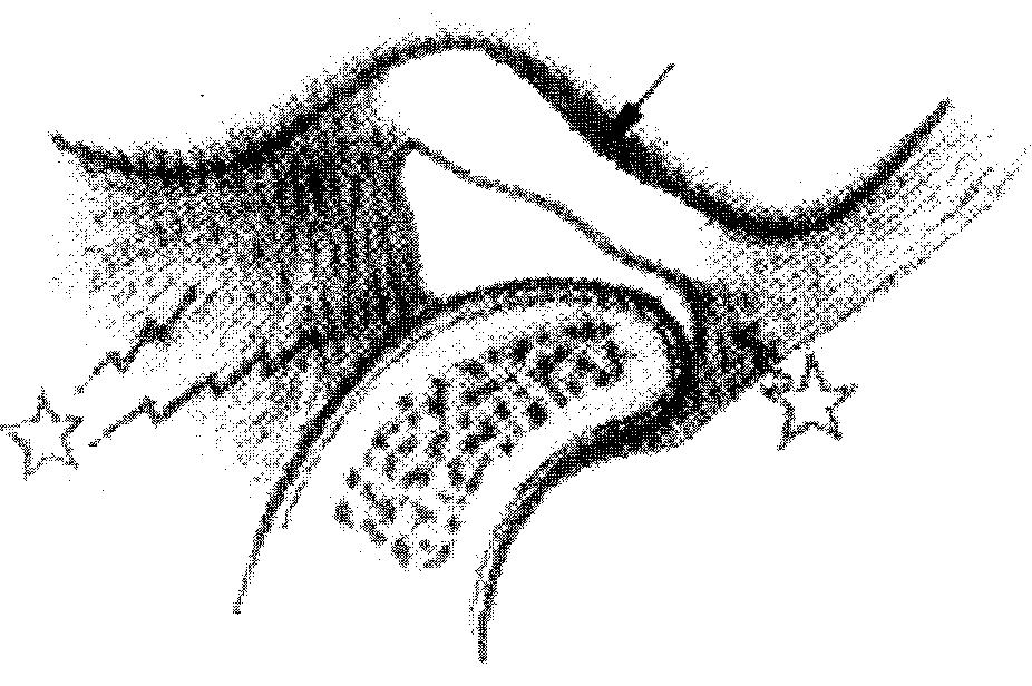 A schematic illustration of the tmj in maximal mouth opening