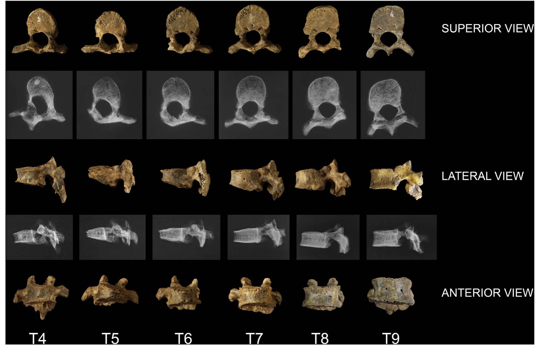 Macroscopic and radiographic images of thoracic segments