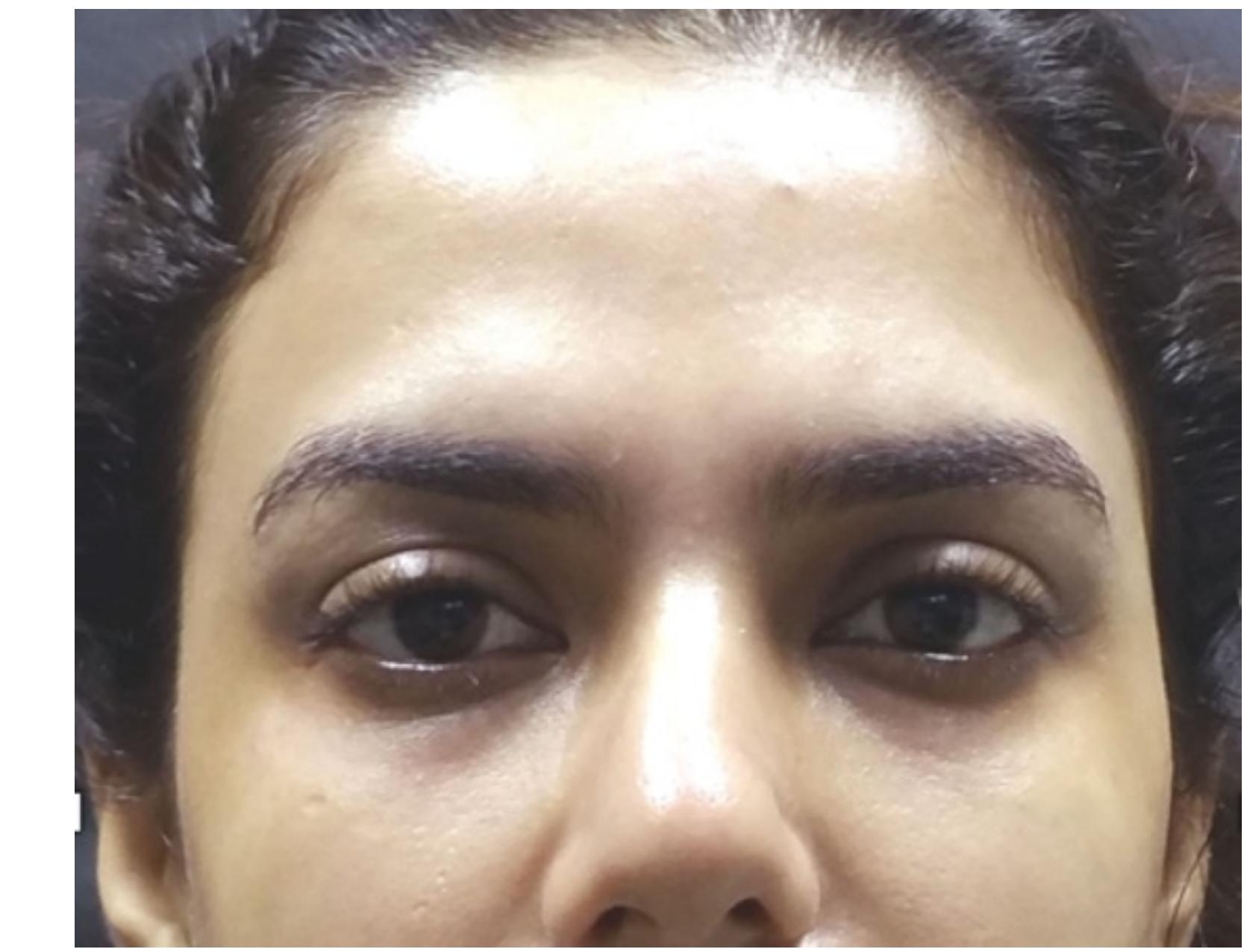 Tear trough before treatment with ha filler