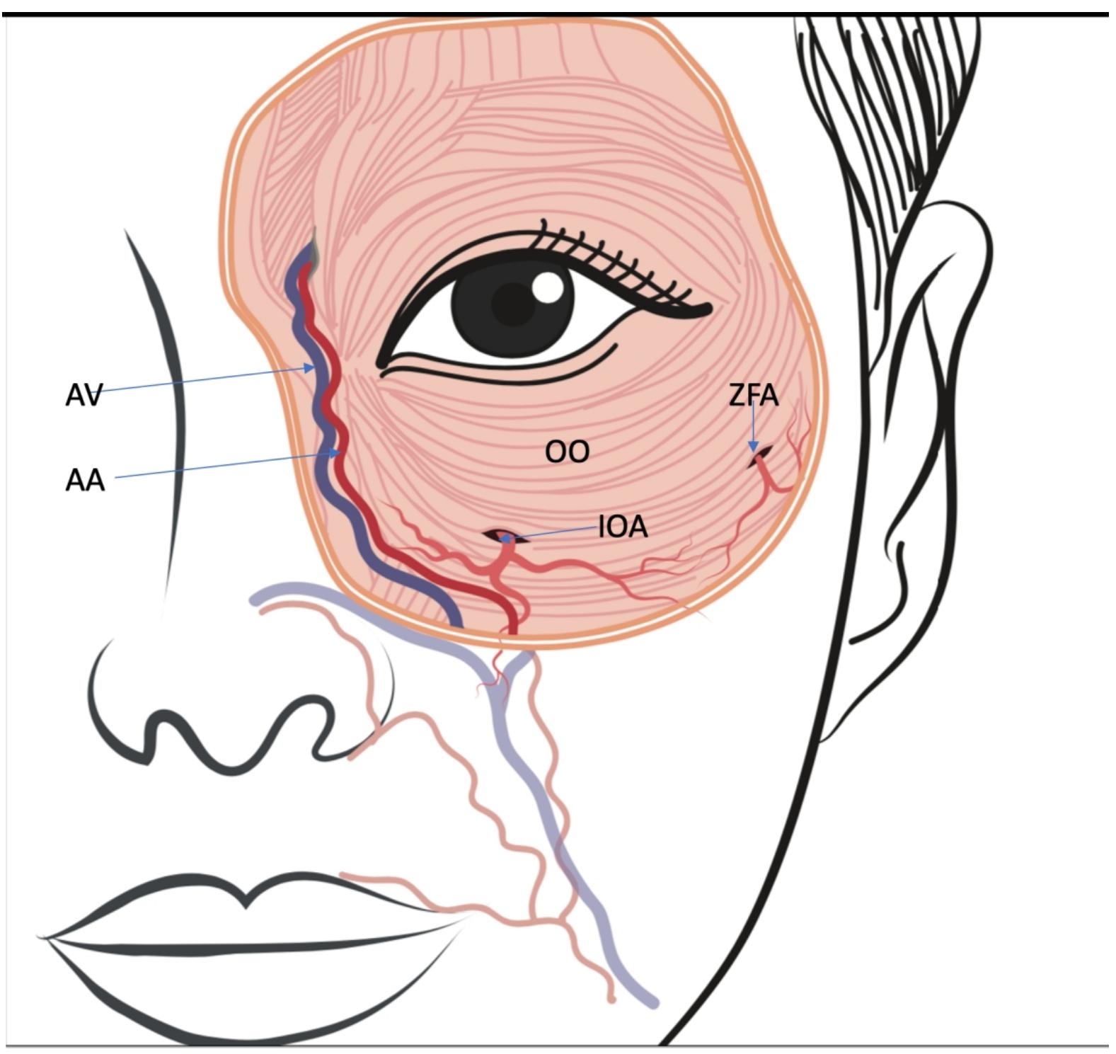 Figure 6 - from Treatment of the tear trough and