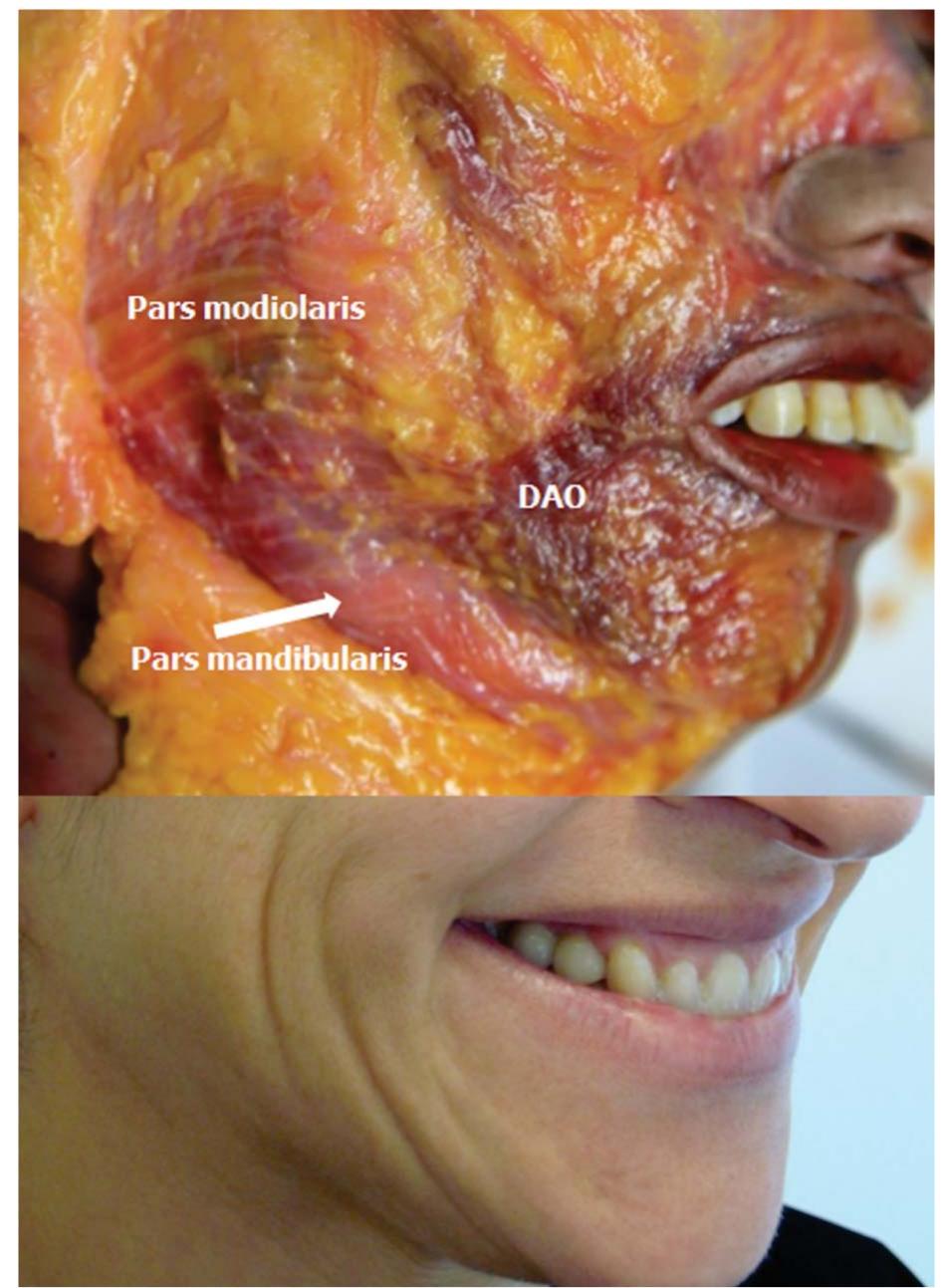 Cadaver dissection showing the platysma pars modiolaris