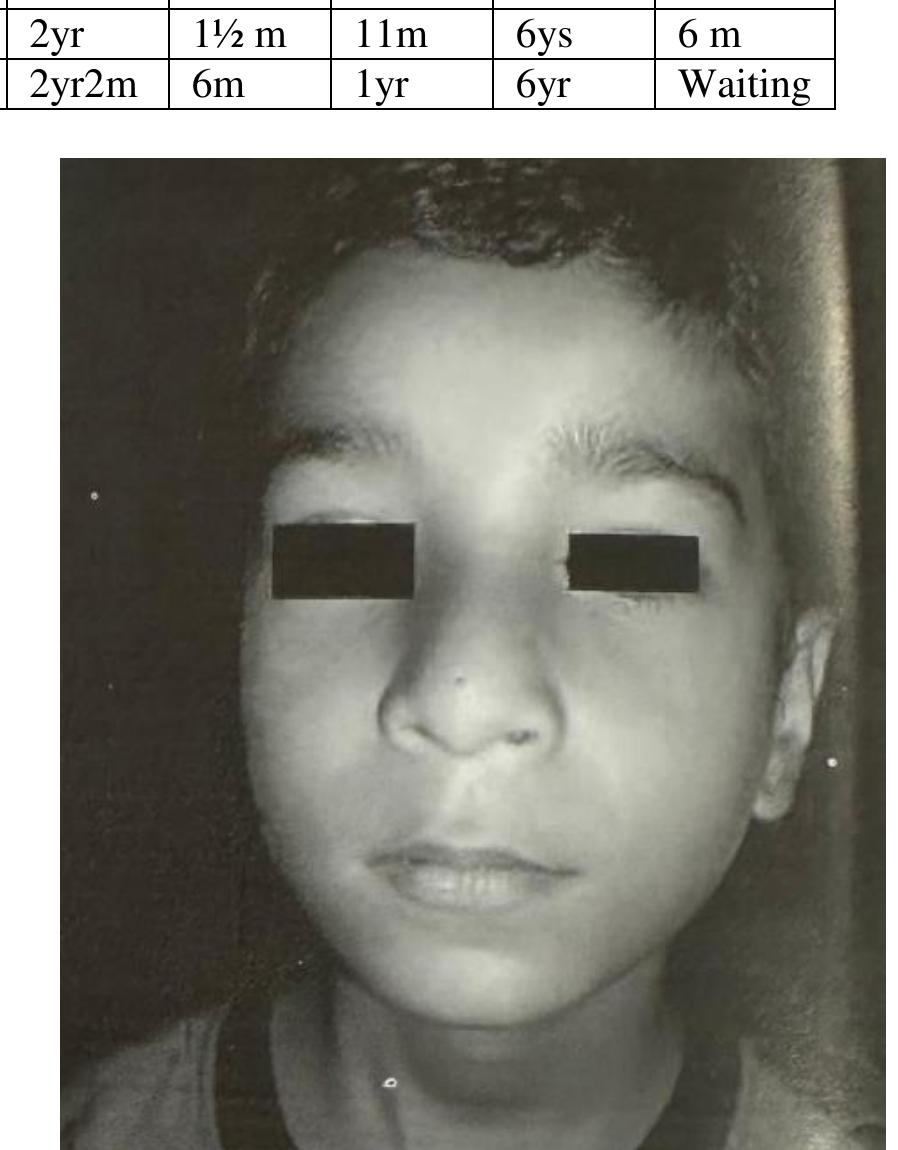 Typical case of congenital nasal dermal sinus table 1: age