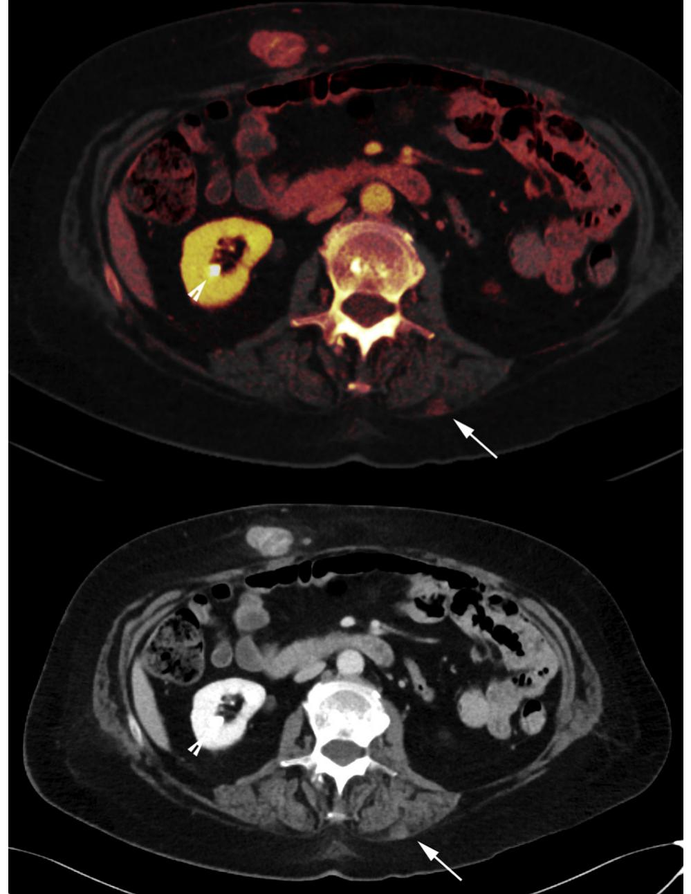 Dect-iodine map (top) and contrast-enhanced ct (bottom) in a