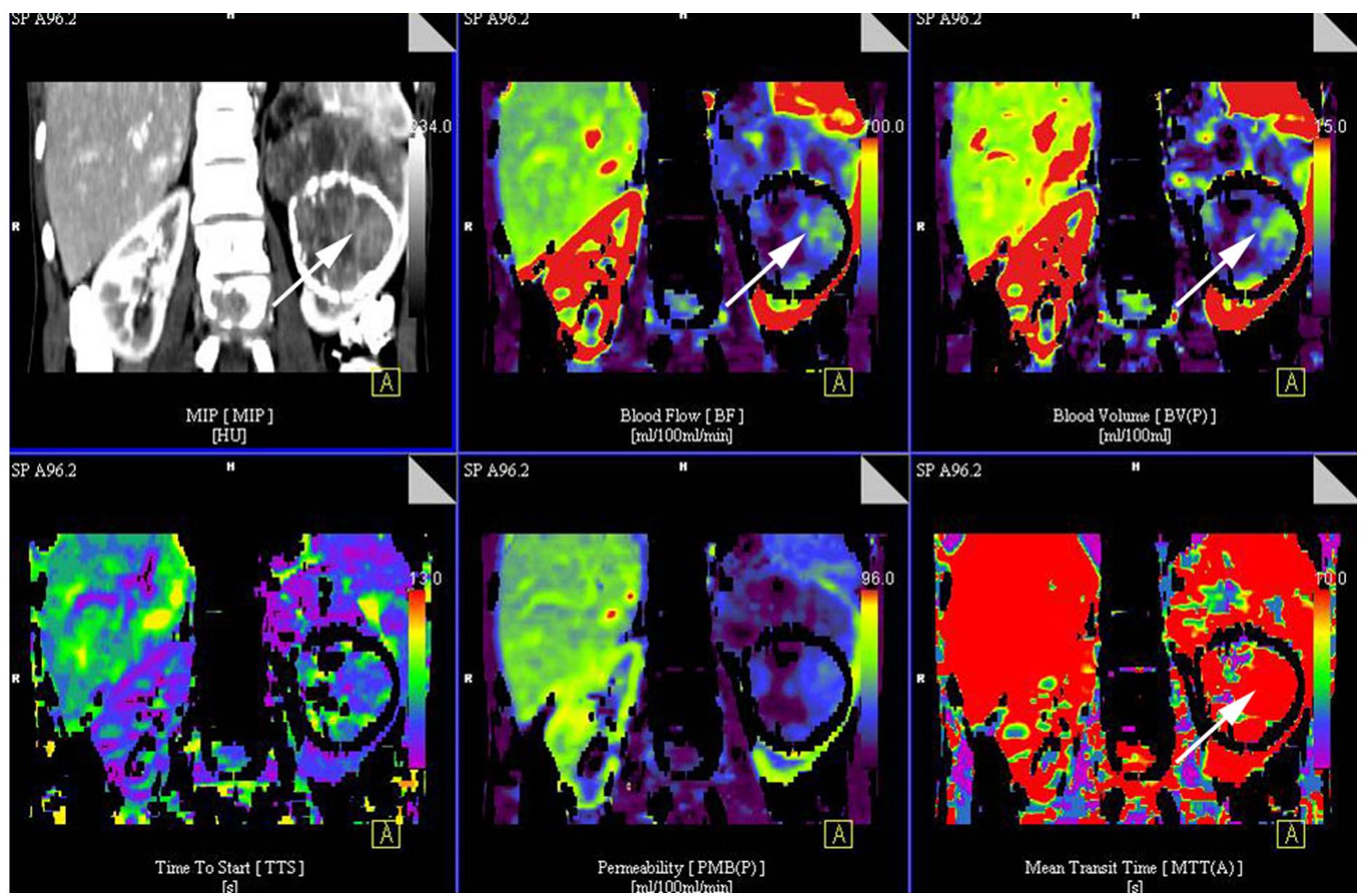 Abdominal iodine map of a patient with metastatic renal cell