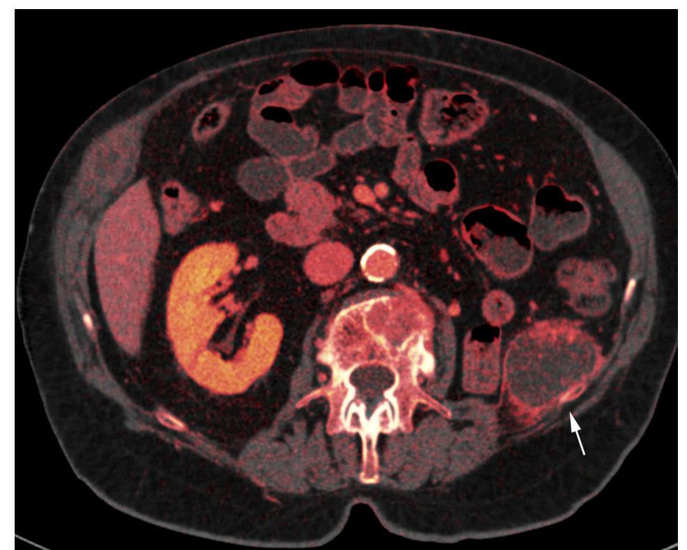 Renal cell carcinoma within complicated renal cyst: