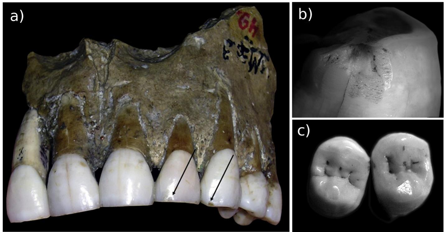 (a) krapina 49 (maxilla e) (kdp 5): grade 1 labial chipping