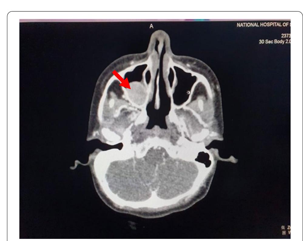 Cect-para nasal sinuses showing an enhancing lesion in the