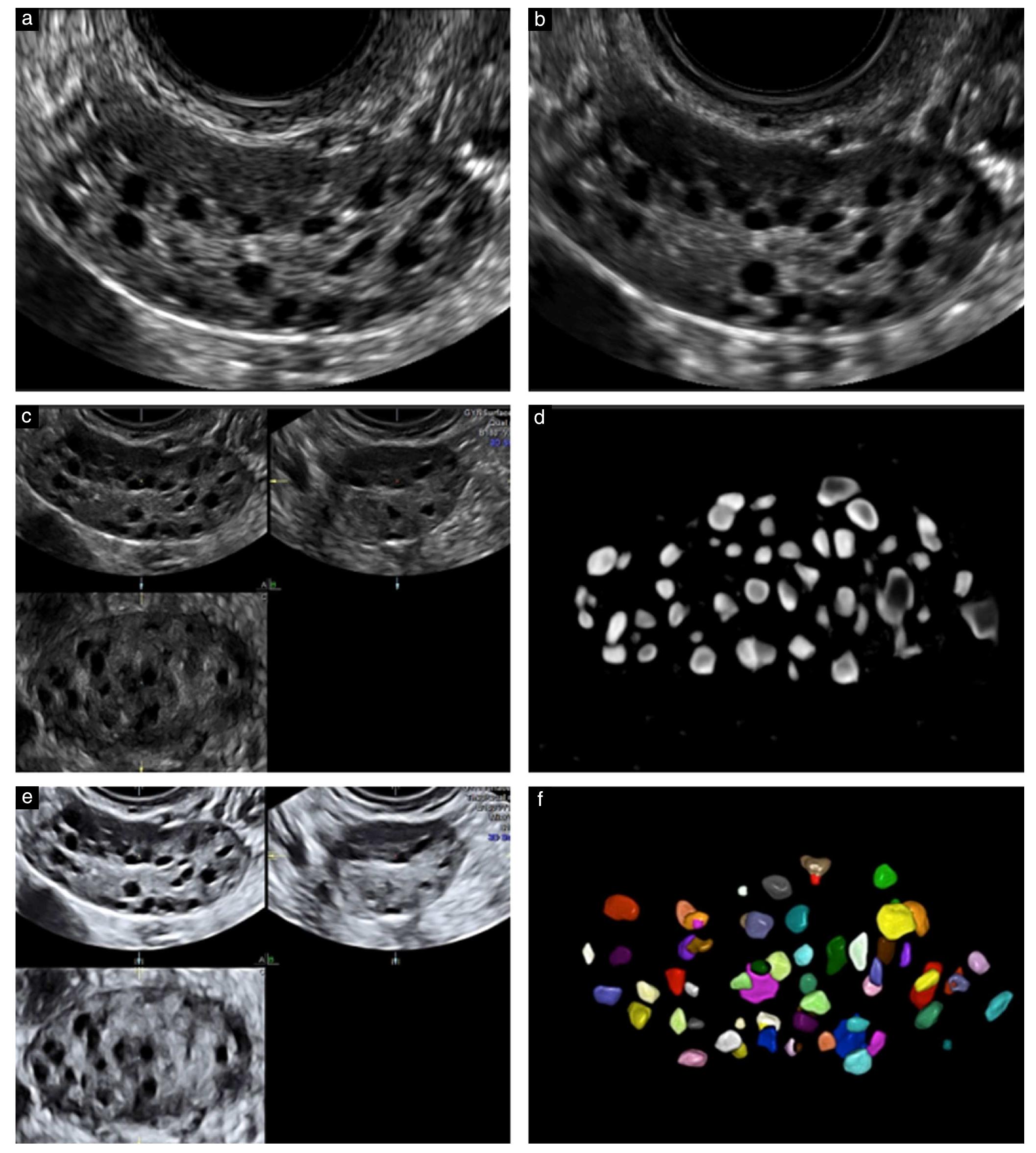Ultrasound imaging of ovary with several follicles: (a)