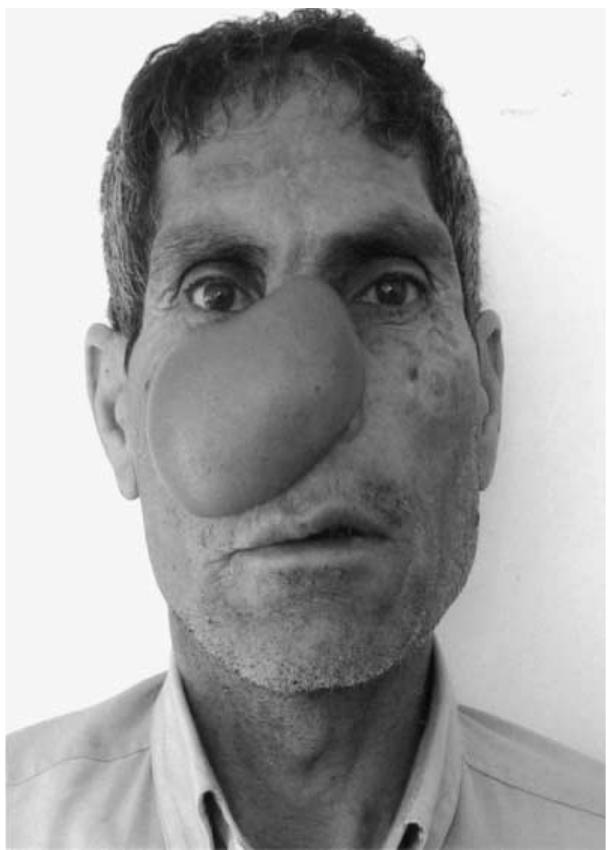 Anterior preoperative view of patient with bulky rectus