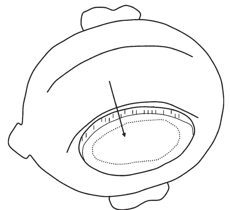 Schema of bipedicle pericranial flap. the flap was mobilized
