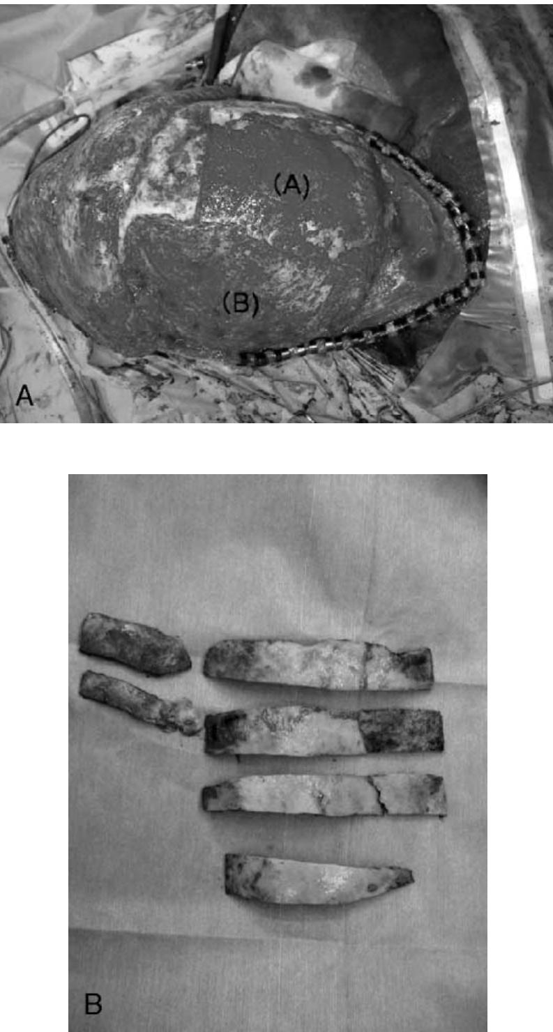 The view when harvesting outer-table calvarial bone from the