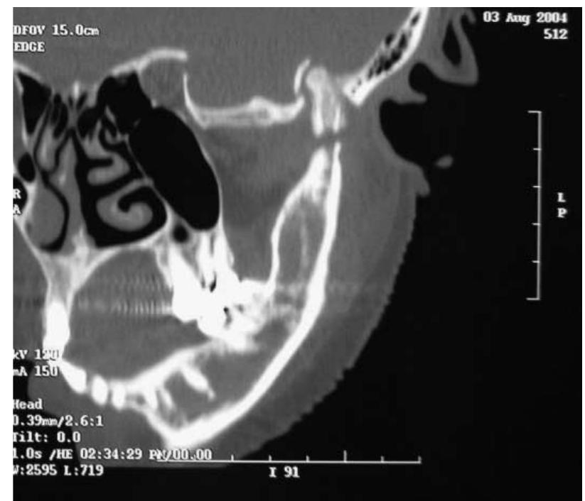 Postoperative sagittal ct scan.