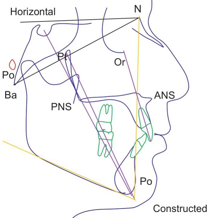 Lateral cephalometric tracing with landmarks and planes usec