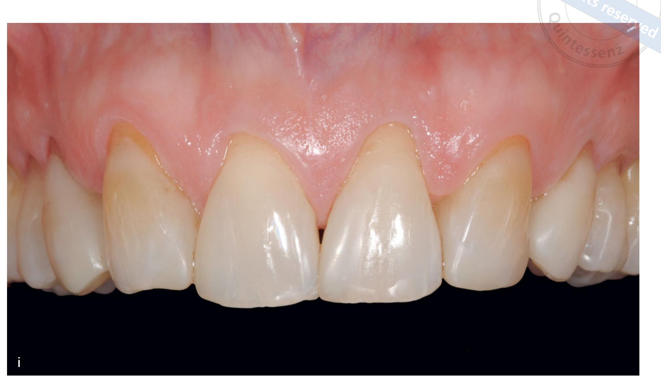 “ig 3 (a to c) preoperative view showing a 50-year-old