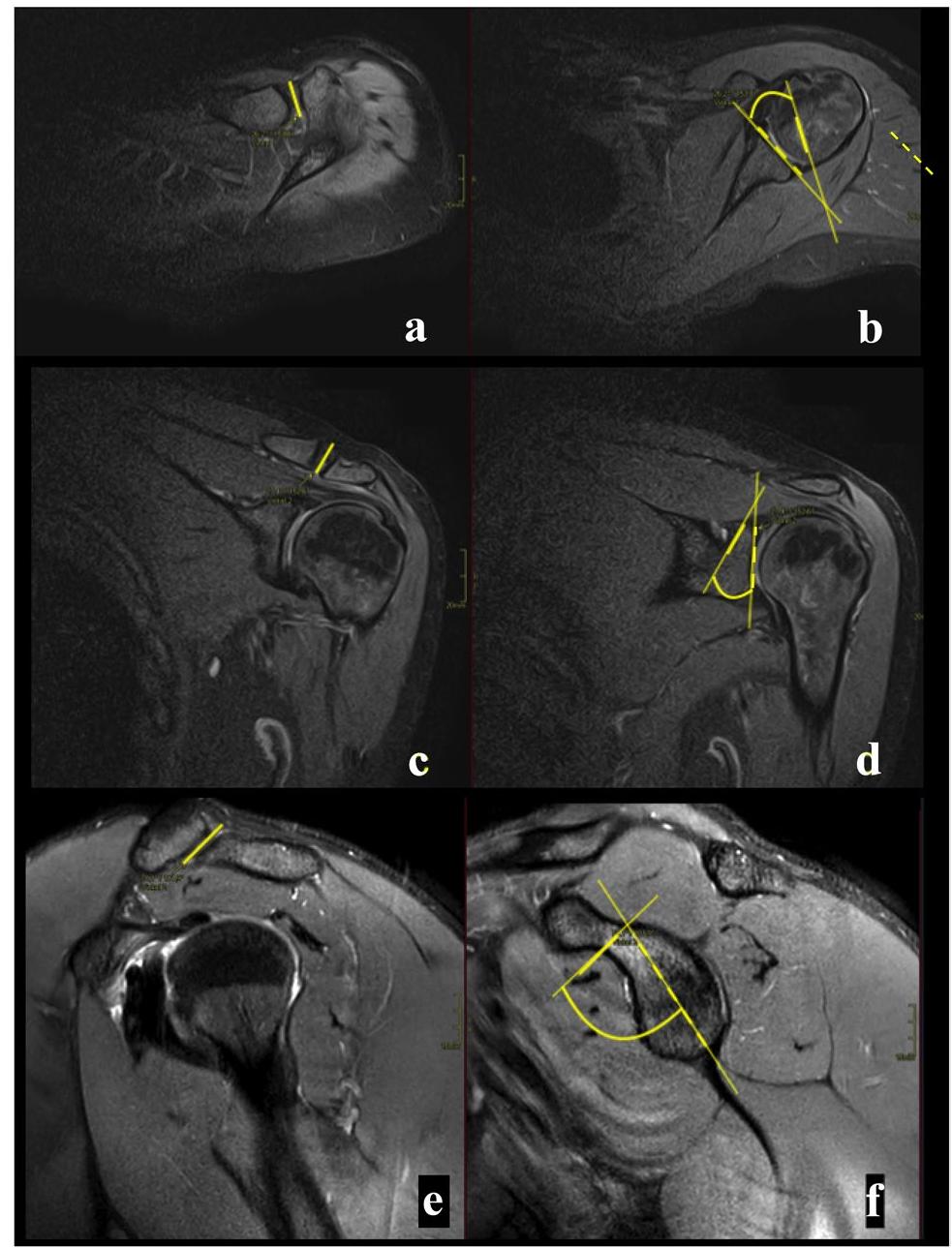 The angles between the acromioclavicular joint (yellow) and