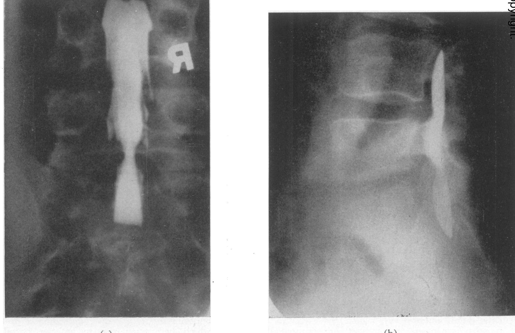 (PDF) Treatment of Lumbar Intervertebral Disc Prolapse